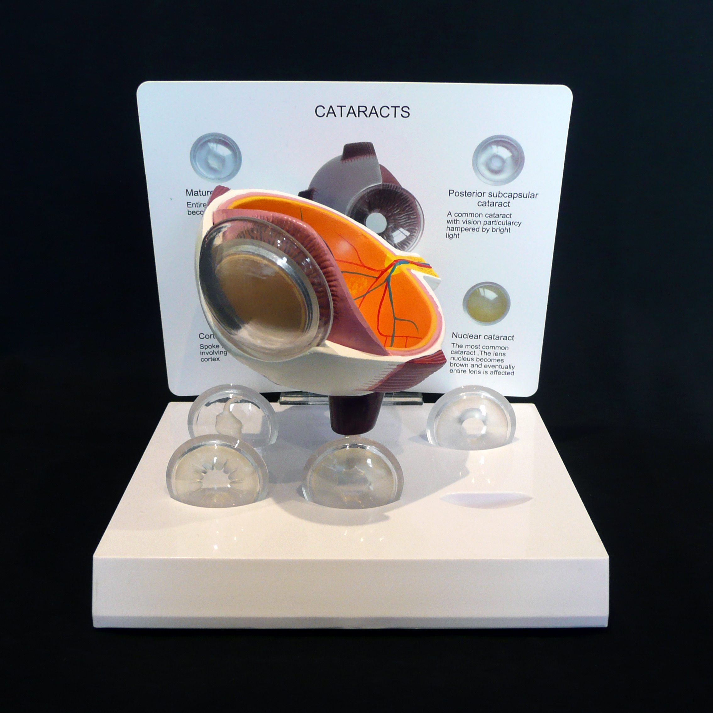 Anatomical Human Cataract Eye Model | Eye Models – Store – Medical Models